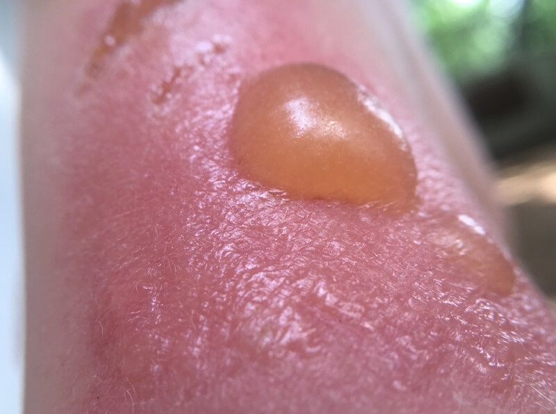 The Science Behind Sunburn Blisters What You Need To Know The Science Behind Sunburn Blisters What You Need To Know